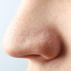 Bouton Sur le Nez : Guide Complet Pour les Éliminer Durablement