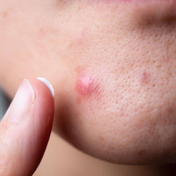 Bouton menton : des solutions simples, des résultats visibles